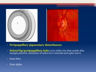 Glaucoma optic disc changes | PPTX