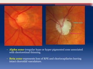 Glaucoma optic disc changes | PPTX