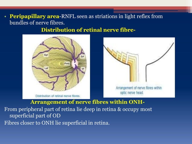 Glaucoma optic disc changes | PPTX | Eye and Vision Conditions ...