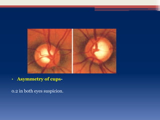 Glaucoma optic disc changes | PPTX