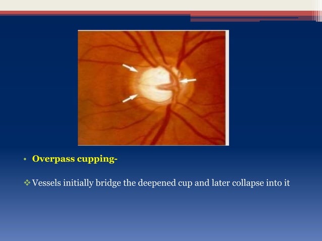 Glaucoma optic disc changes