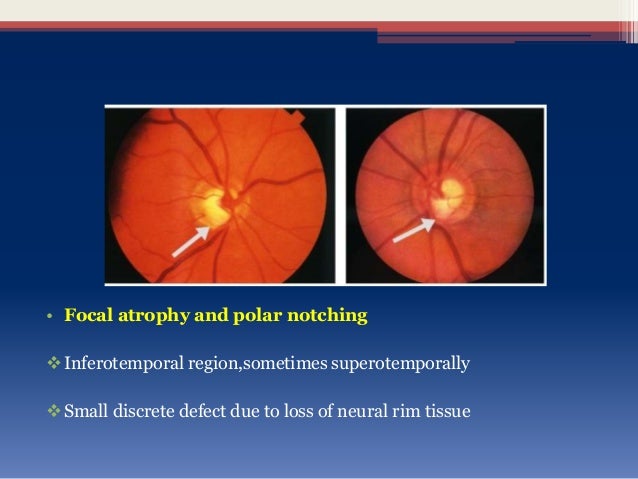 Glaucoma optic disc changes