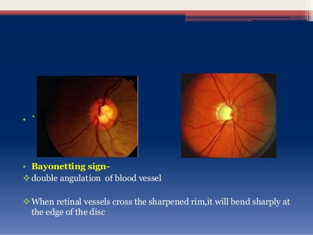 Glaucoma optic disc changes