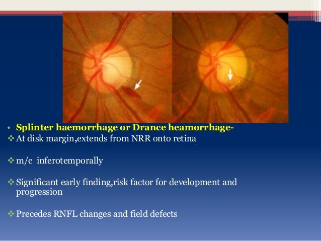 Glaucoma optic disc changes