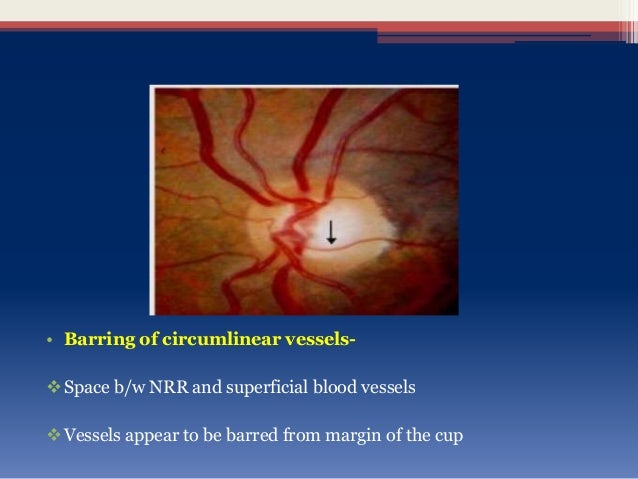 Glaucoma optic disc changes