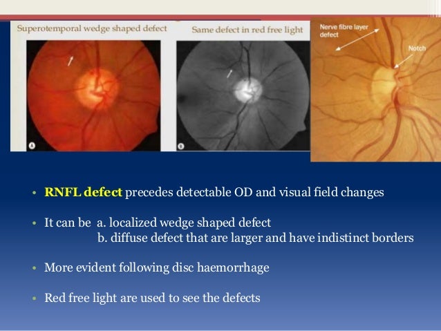 Glaucoma optic disc changes
