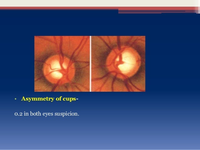 Glaucoma optic disc changes