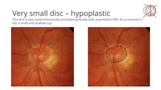 Glaucoma Optic Neuropathy Evaluation - EVALUATION -GONE.pptx