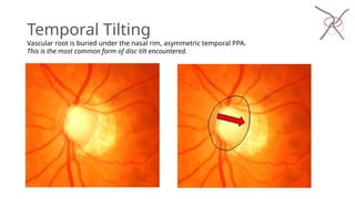 Glaucoma Optic Neuropathy Evaluation - EVALUATION -GONE.pptx