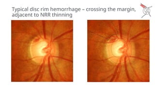 Glaucoma Optic Neuropathy Evaluation - EVALUATION -GONE.pptx