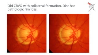 Glaucoma Optic Neuropathy Evaluation - EVALUATION -GONE.pptx