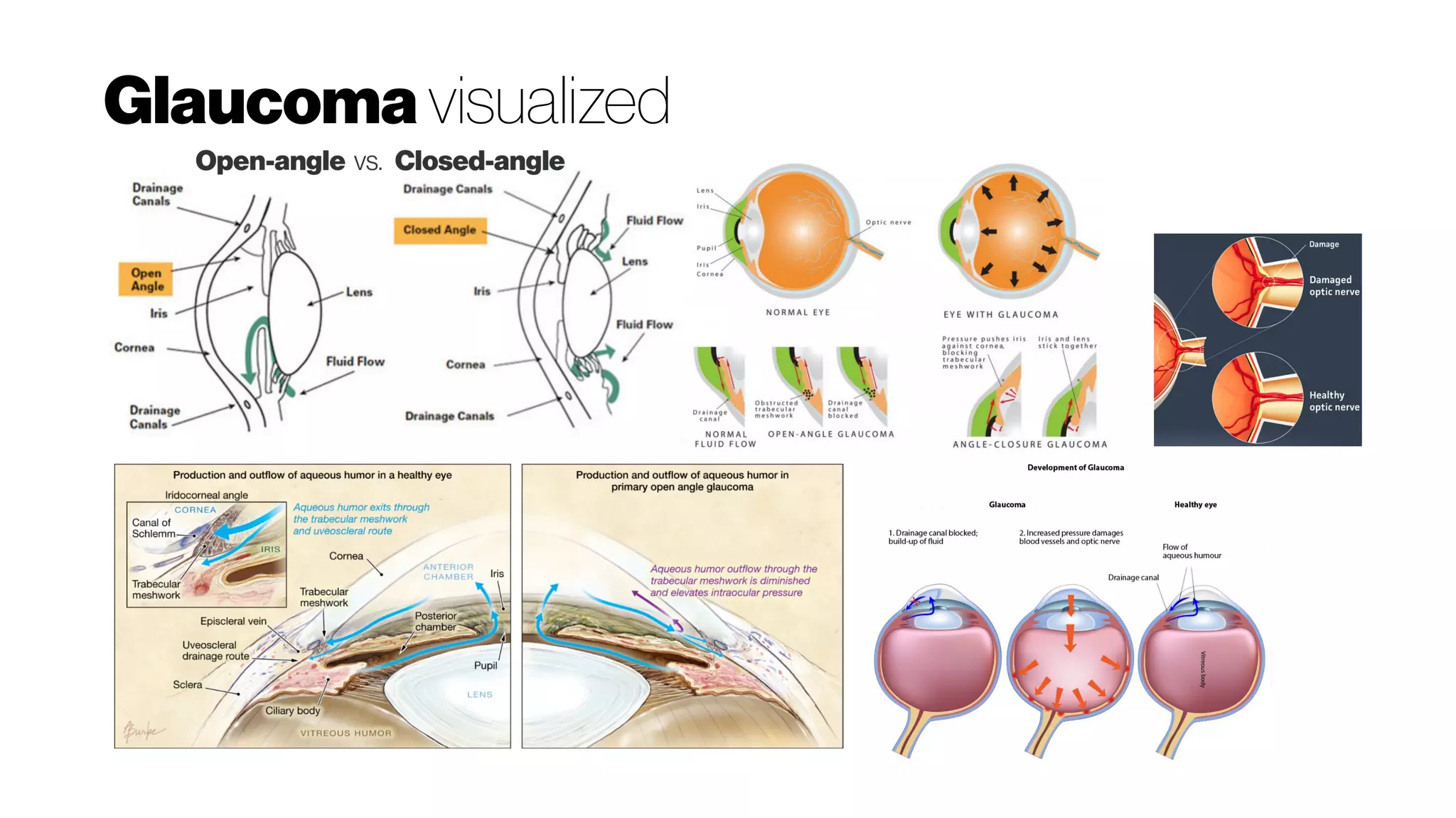 Glaucoma | PDF