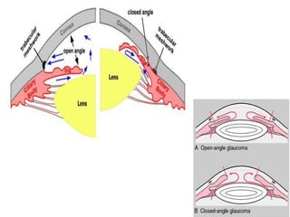 Glaucoma Definition, Introduction, Etiology, Epidemiology, Clinical ...
