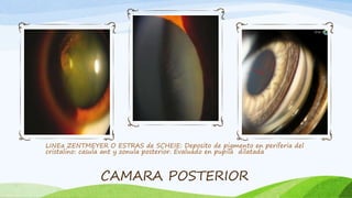 Glaucoma pigmentario | PPTX