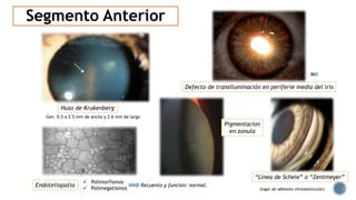 Sindrome de dispersión pigmentaria y Glaucoma pigmentario | PPTX