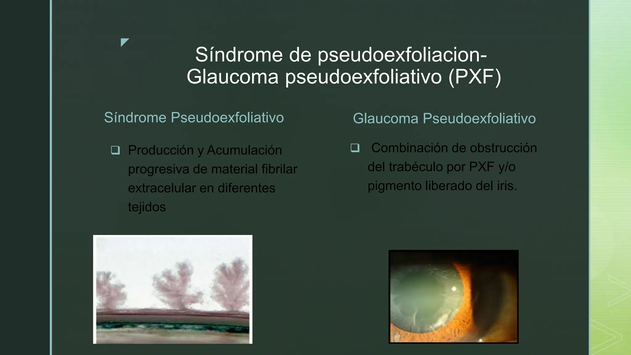 glaucoma pigmentario y Glaucoma pseudoexfoliativo .pptx
