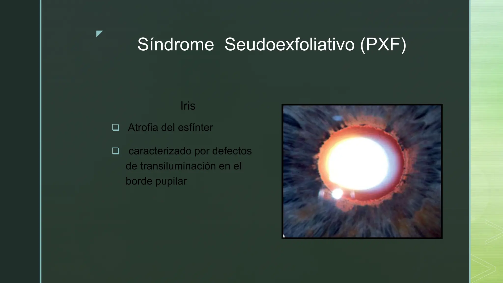 glaucoma pigmentario y Glaucoma pseudoexfoliativo .pptx
