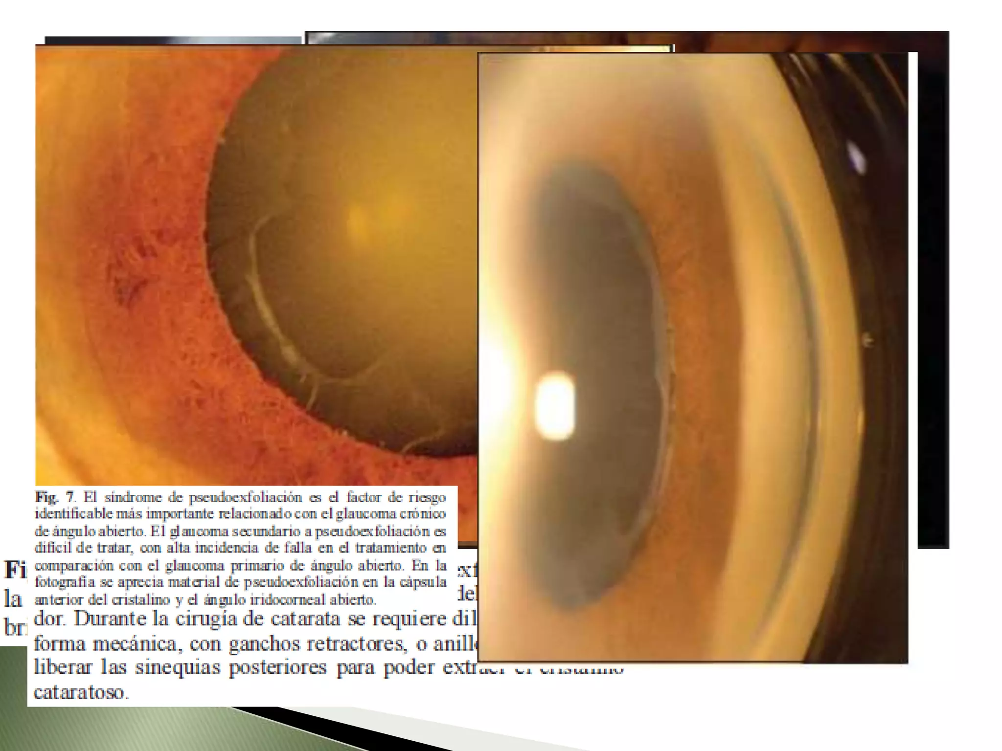Glaucoma por pseudoexfoliación y neovascular | PPTX