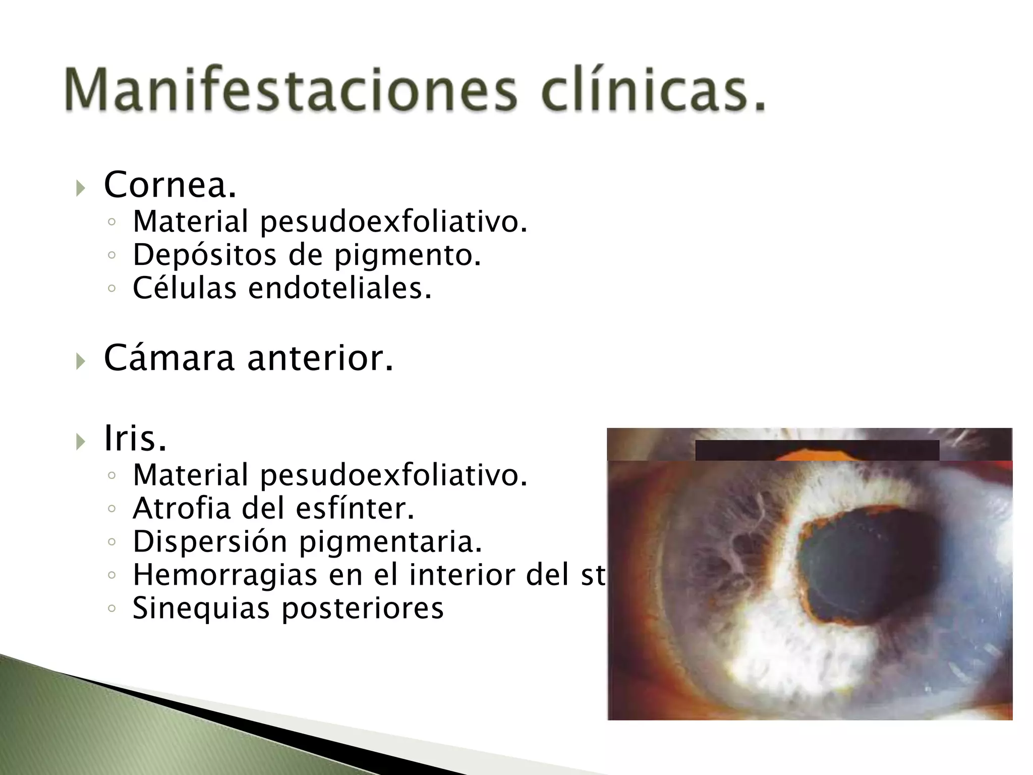 Glaucoma por pseudoexfoliación y neovascular | PPTX