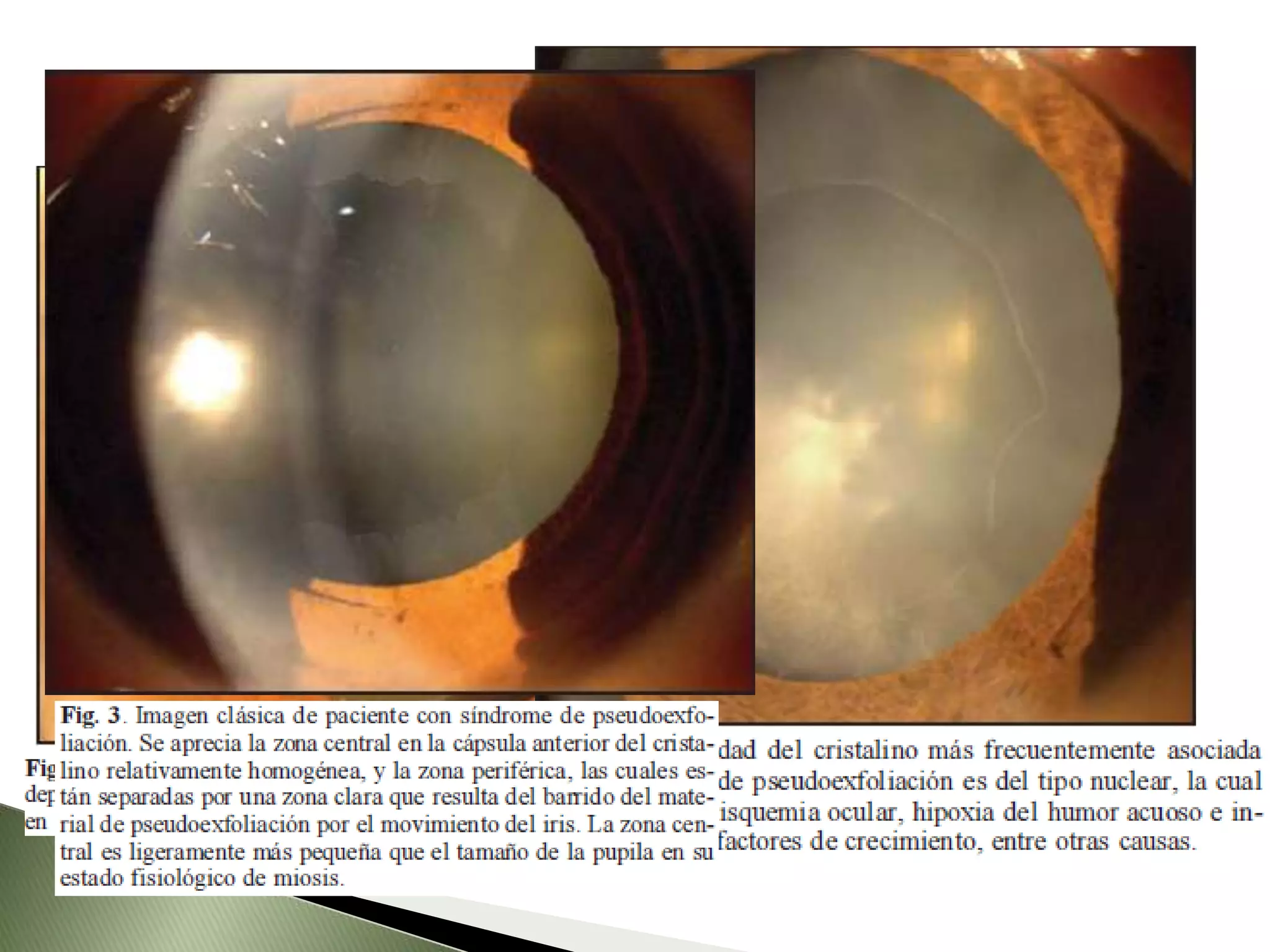 Glaucoma por pseudoexfoliación y neovascular | PPTX