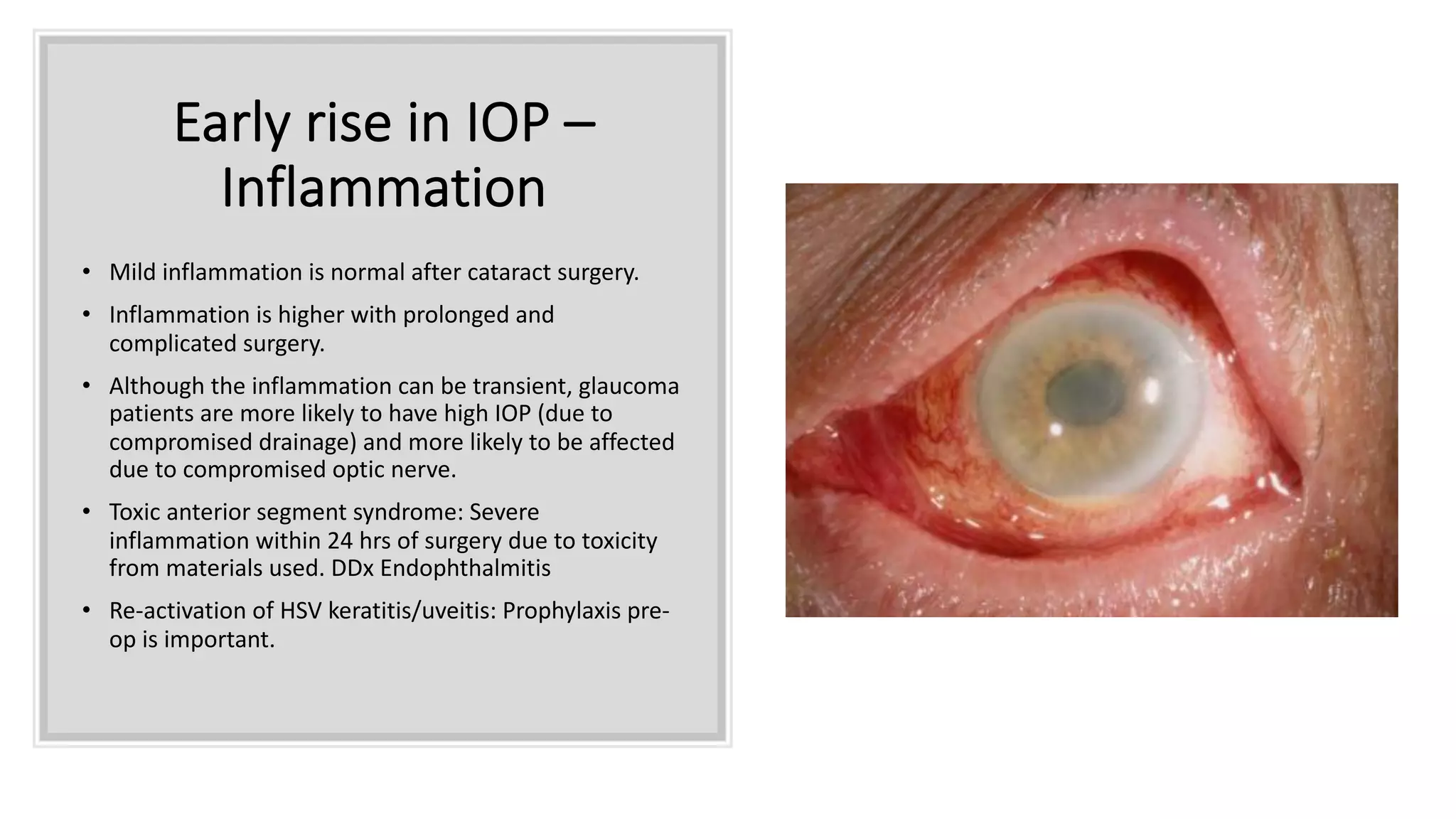 Glaucoma post cataract surgery | PDF