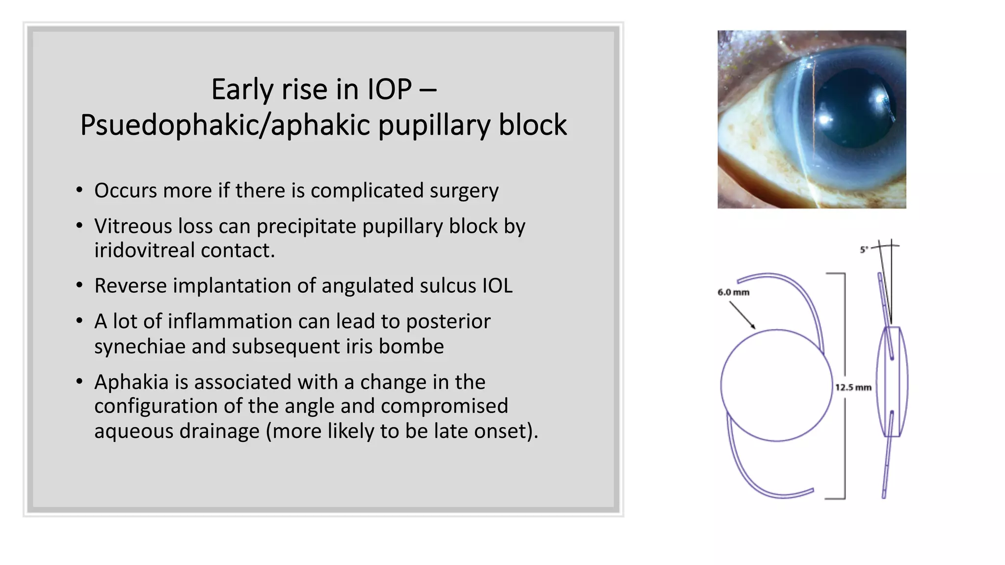 Glaucoma post cataract surgery | PDF