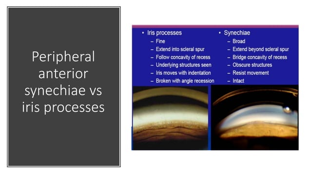 Glaucoma post cataract surgery | PDF | Eye and Vision Conditions ...