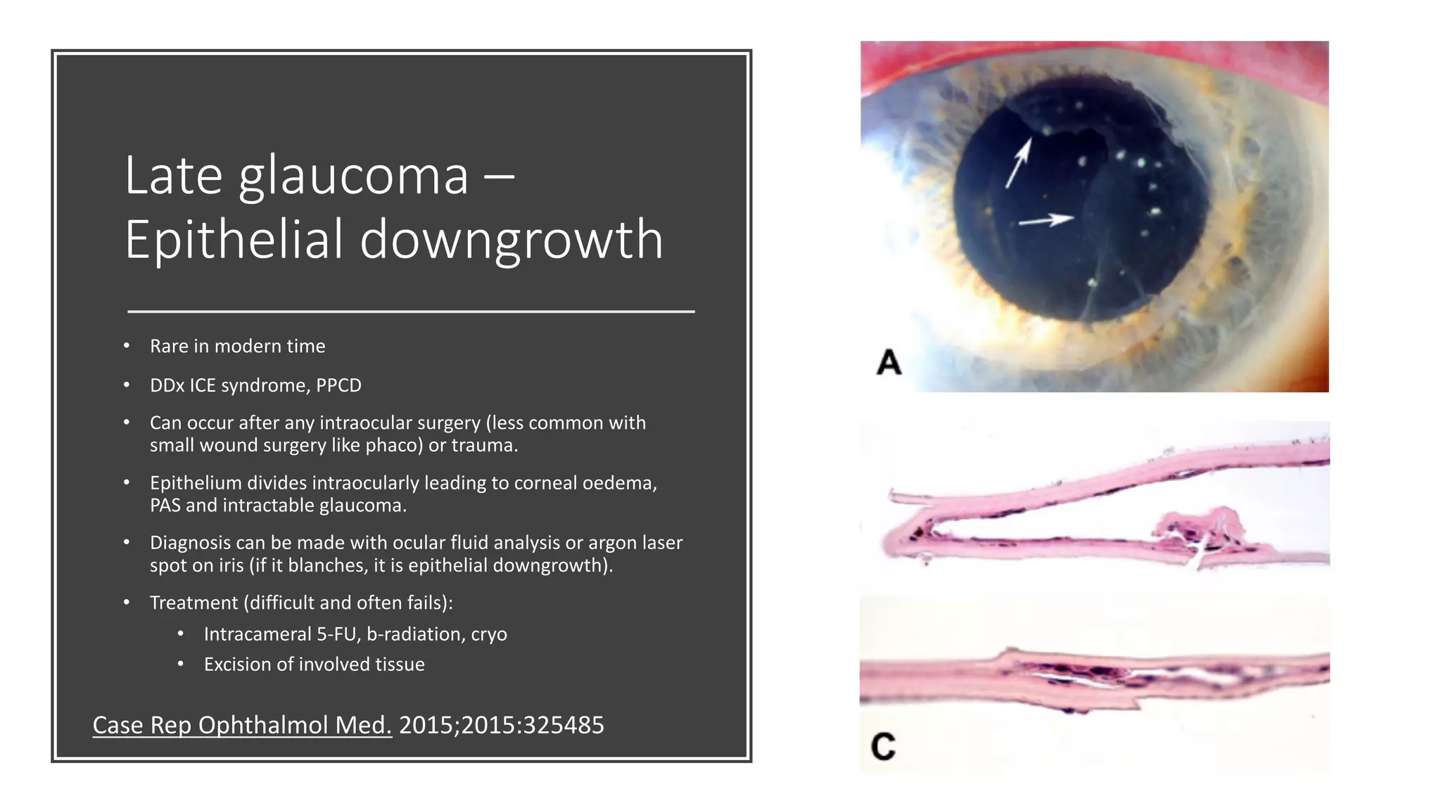 Glaucoma post cataract surgery .pdf