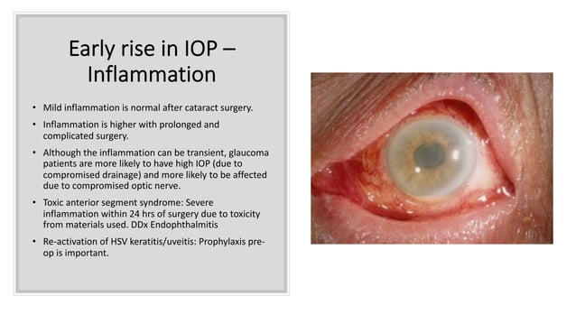 Glaucoma post cataract surgery .pdf