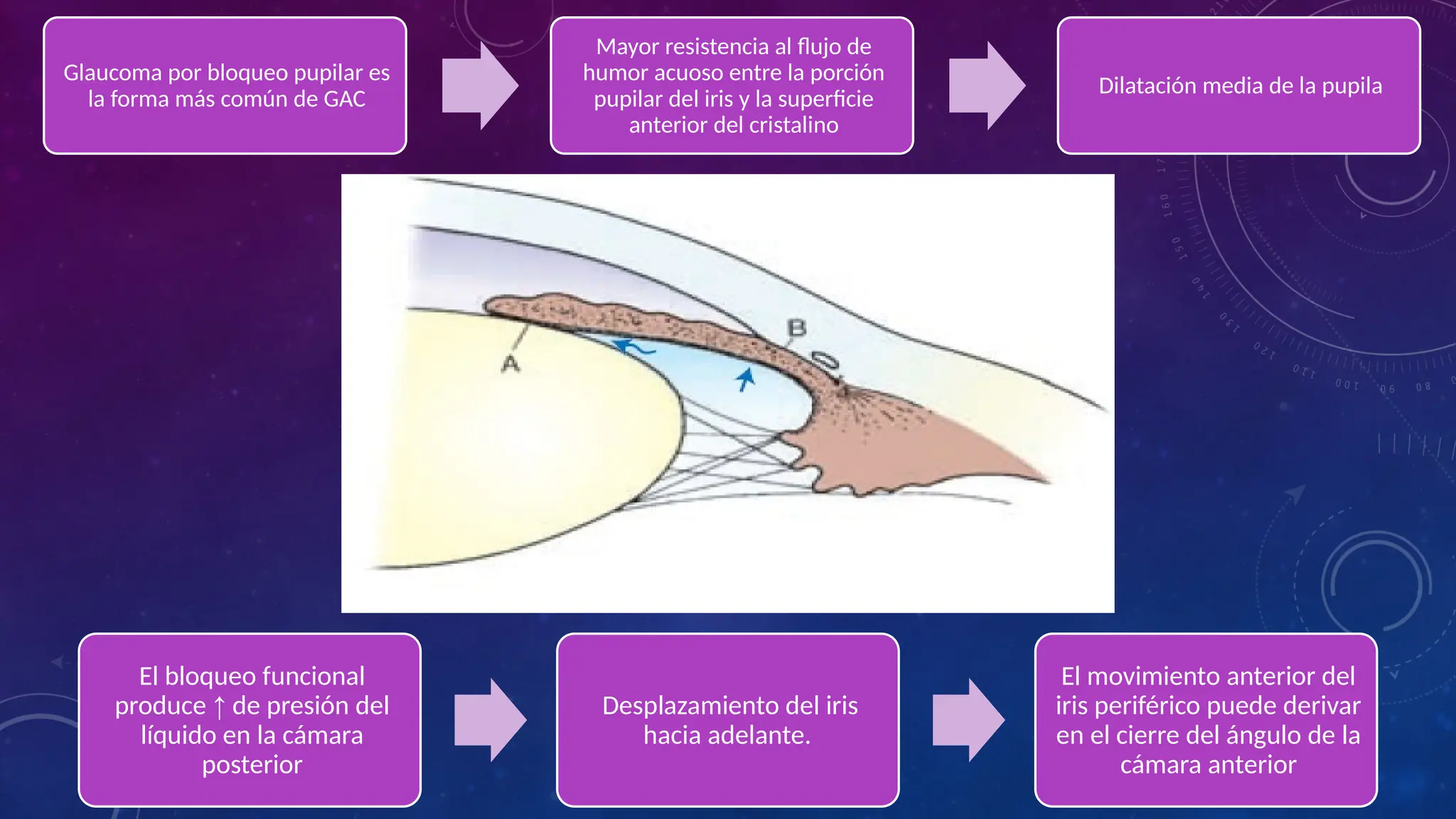 Glaucoma POST QUIRURGICO por bloqueo pupilar.pptx