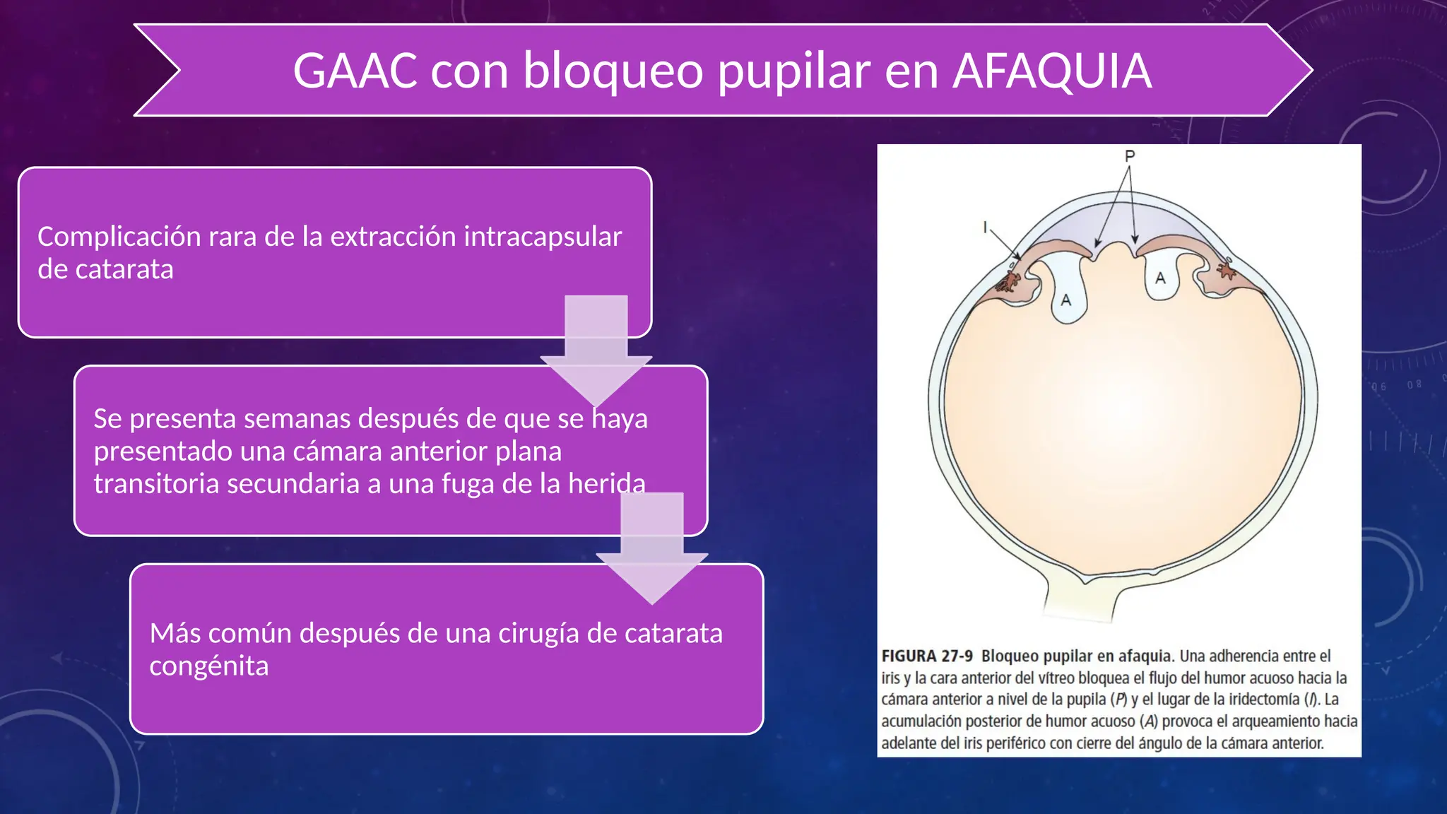 Glaucoma POST QUIRURGICO por bloqueo pupilar.pptx