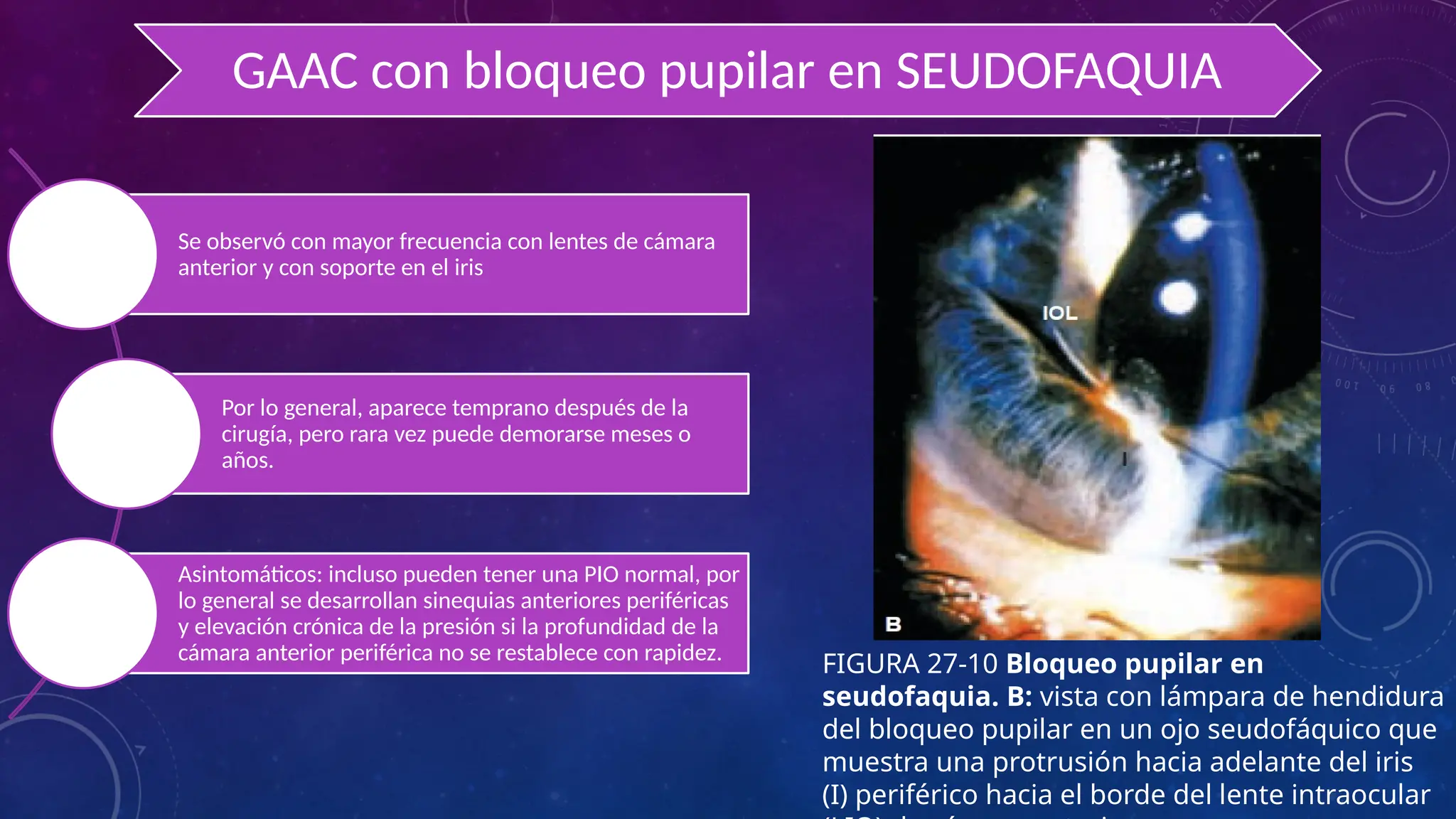 Glaucoma POST QUIRURGICO por bloqueo pupilar.pptx