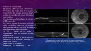 Glaucoma POST QUIRURGICO por bloqueo pupilar.pptx