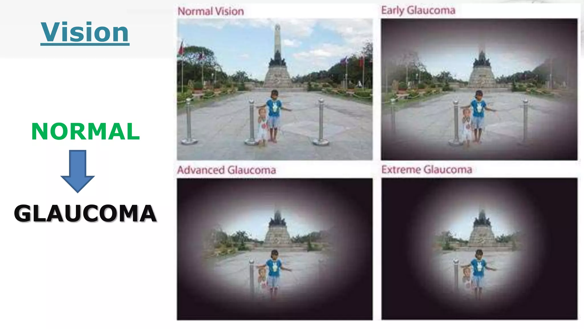 Glaucoma ppt. | PPTX