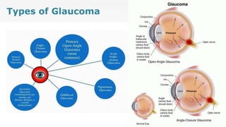 Glaucoma ppt. | PPTX