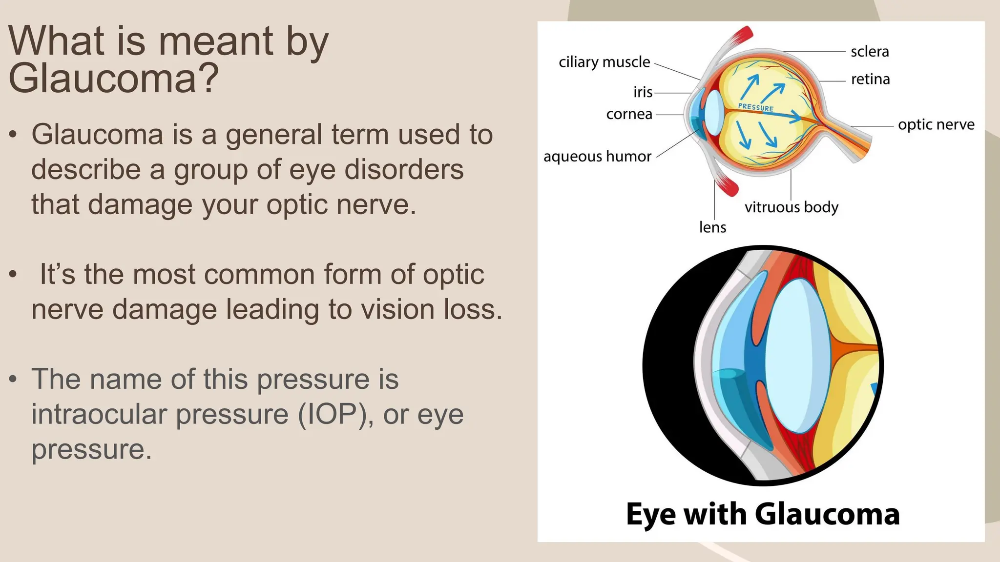 Glaucoma Screening Test by Segmentation of Optical Disc & Cup Using ...