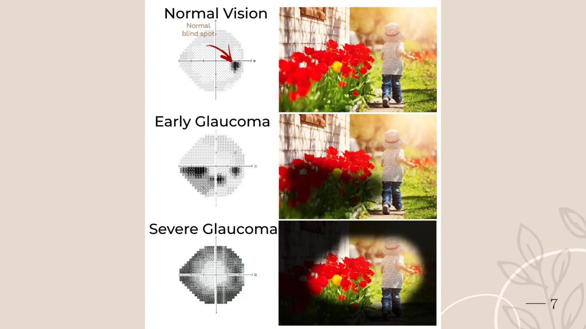 Glaucoma Screening Test By Segmentation Of Optical Disc And Cup Using Matlab Ppt
