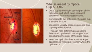 Glaucoma Screening Test by Segmentation of Optical Disc & Cup Using ...