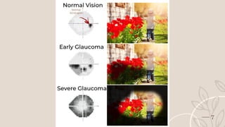 Glaucoma Screening Test by Segmentation of Optical Disc & Cup Using ...