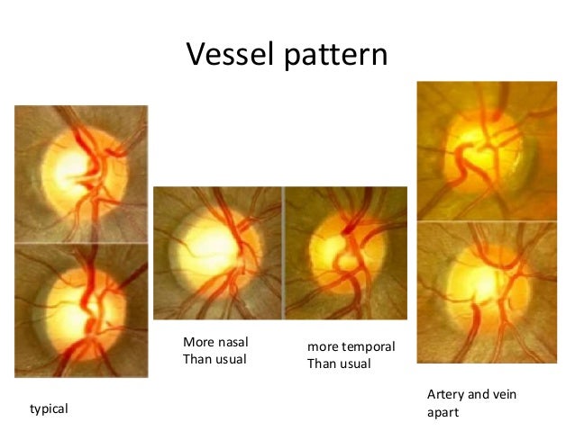 Glaucoma ppt kiran oli