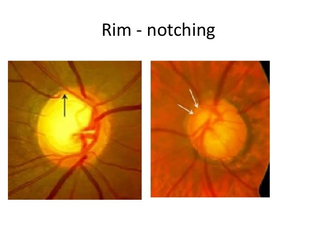 Glaucoma ppt kiran oli