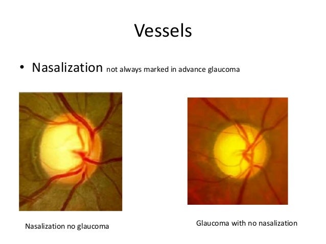 Glaucoma ppt kiran oli