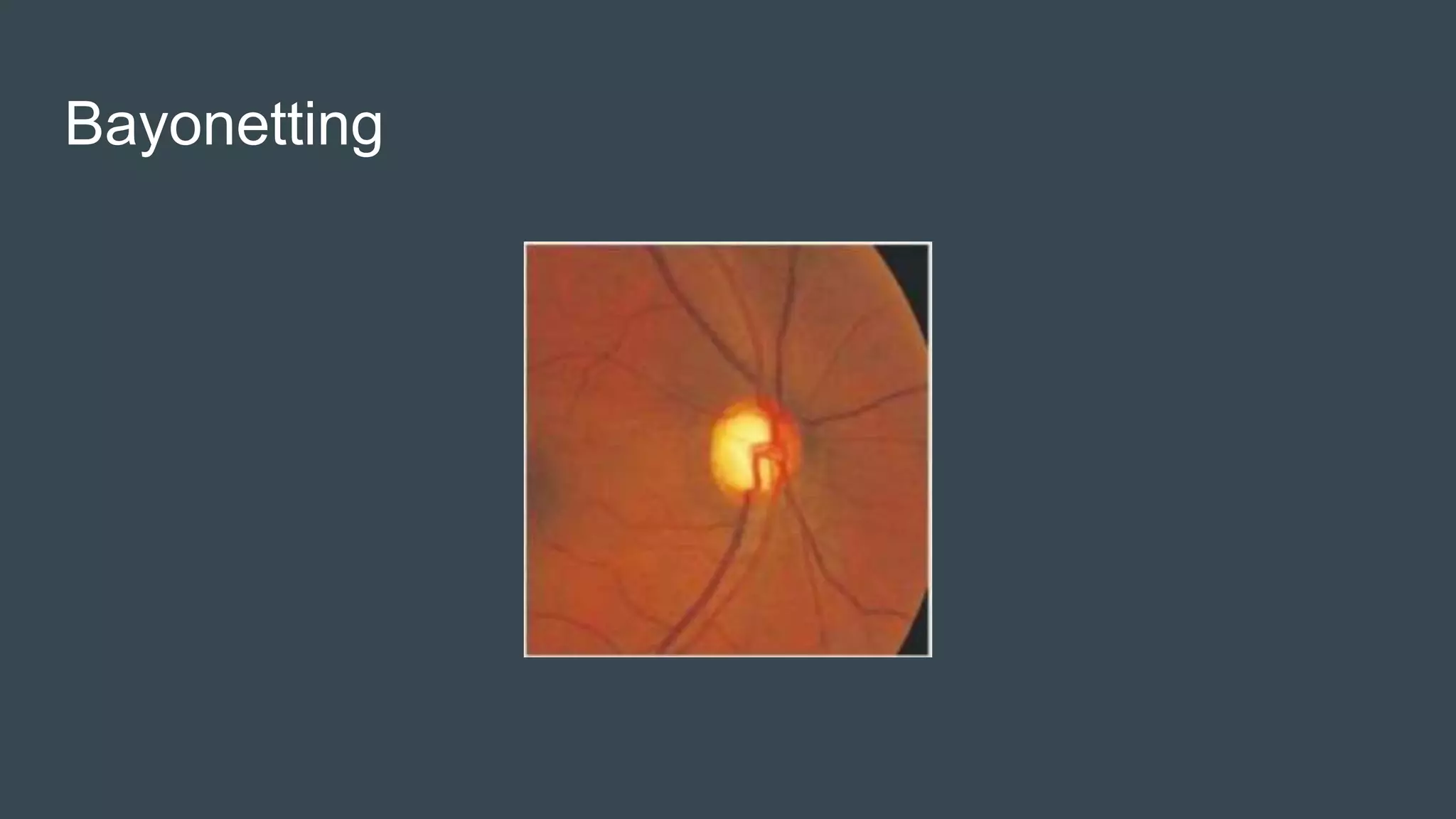 Glaucoma: Preferred Practice Patterns | PPTX