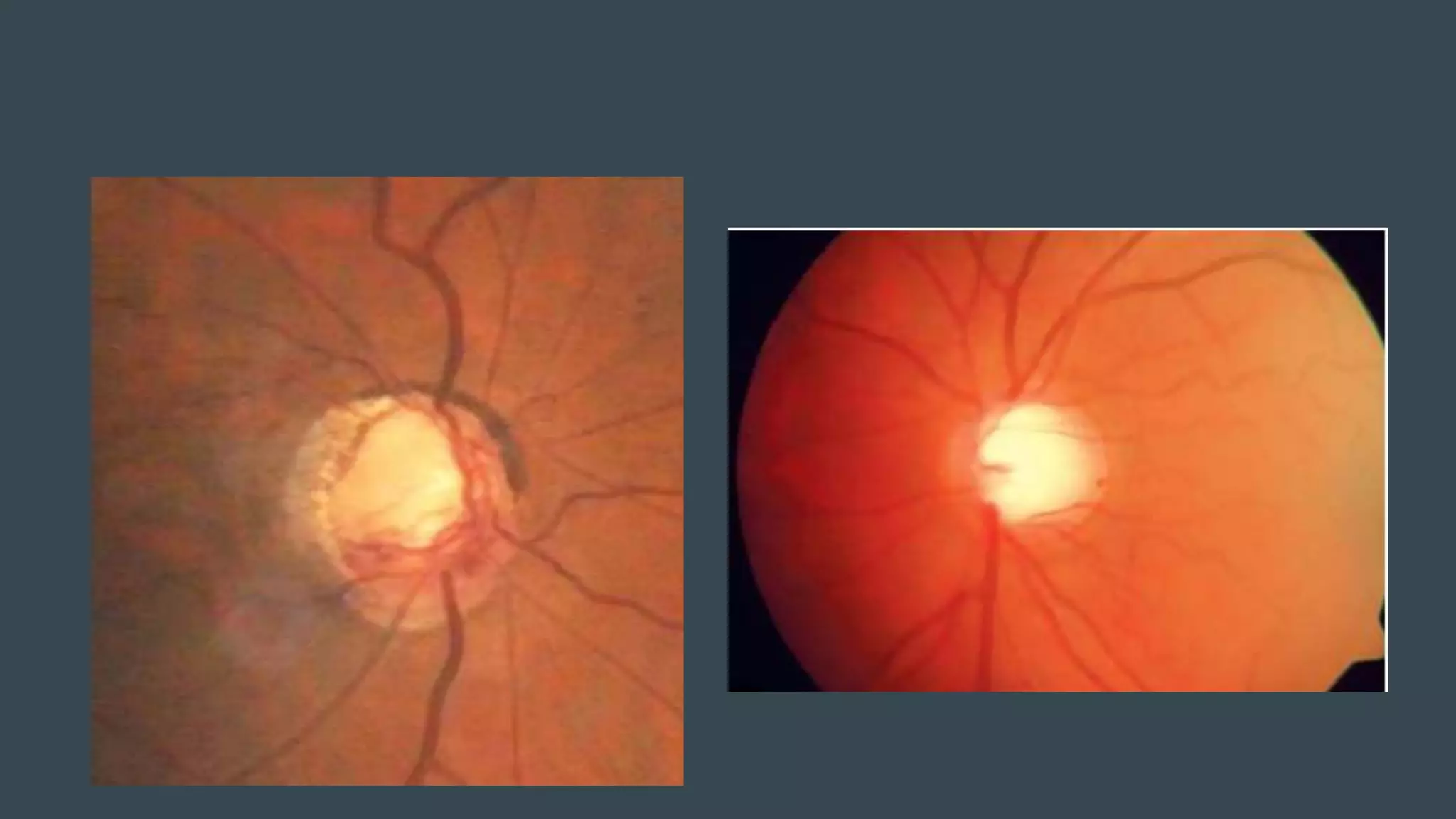 Glaucoma: Preferred Practice Patterns | PPTX