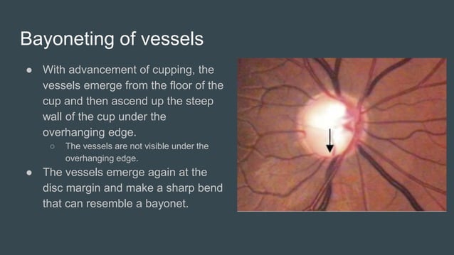 Glaucoma: Preferred Practice Patterns