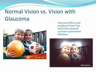 Glaucoma prevention | PPTX