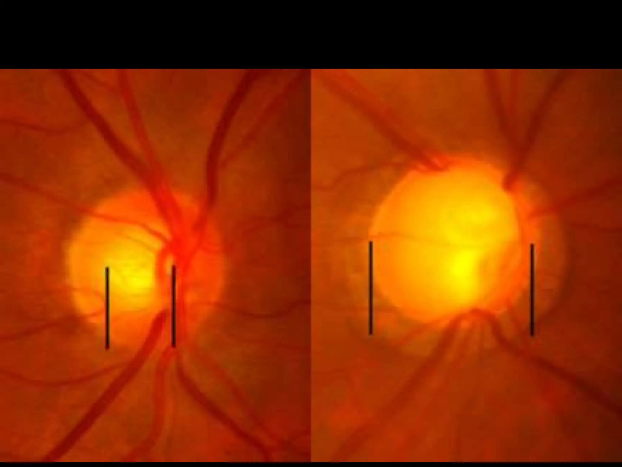 Glaucoma revision | PPT