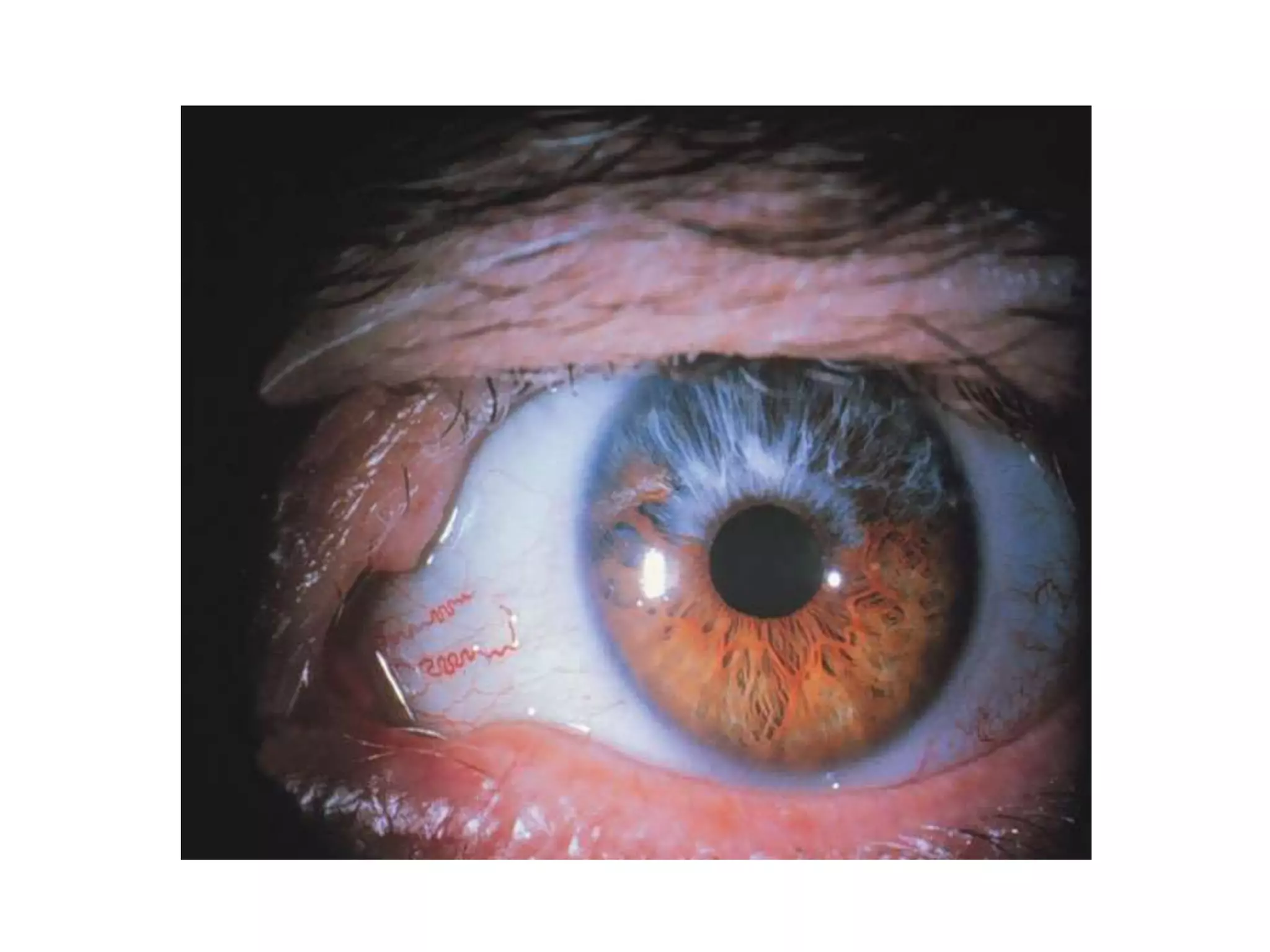 Glaucoma revision | PPT