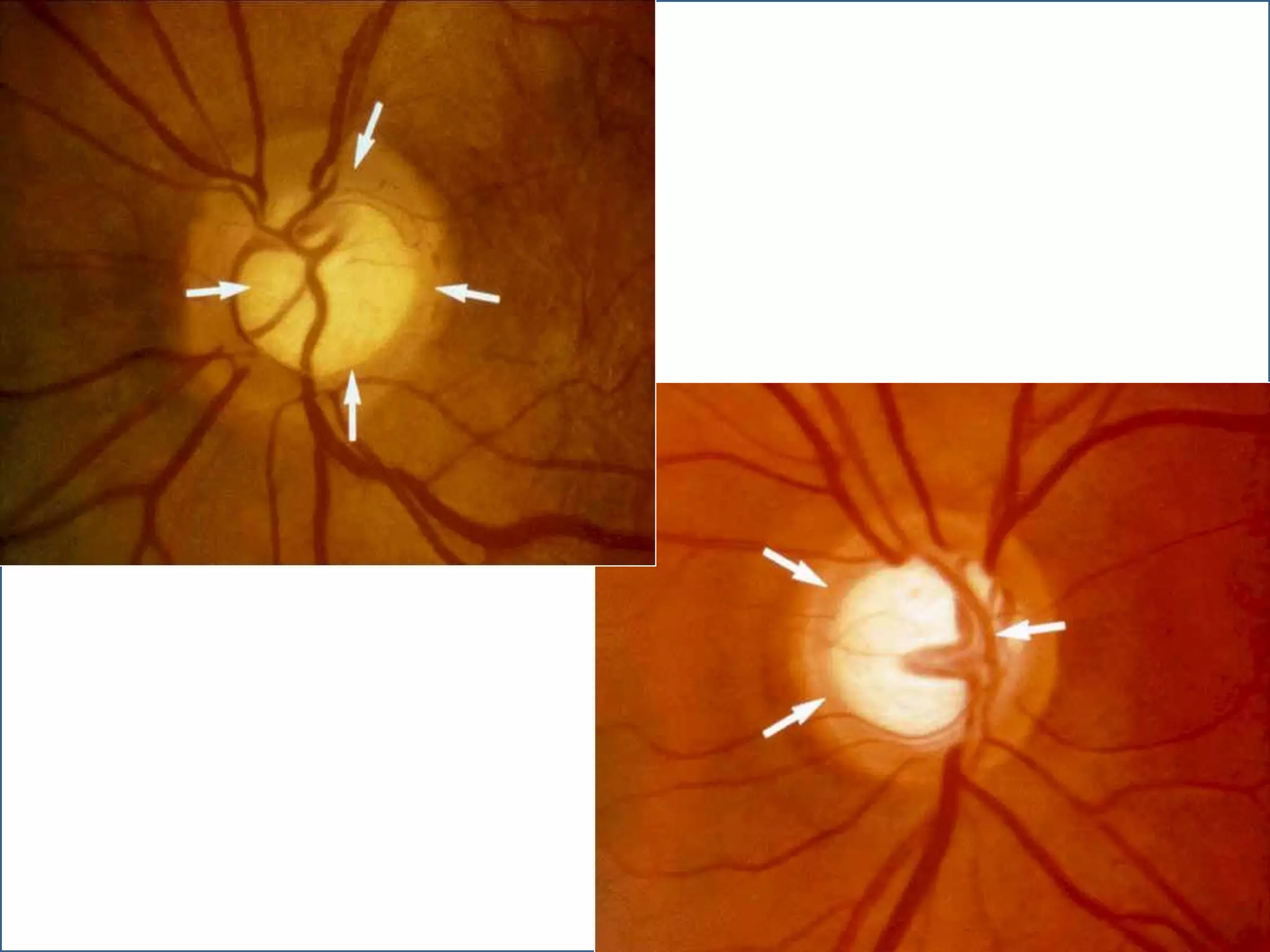 Glaucoma revision | PPT
