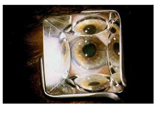 Glaucoma revision | PPT